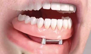 Klikgebit - Prothese specialist Grou